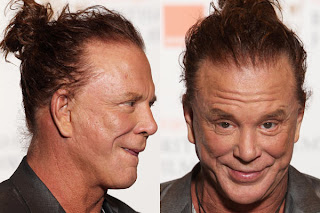 Mickey Rourke Plastic Surgery