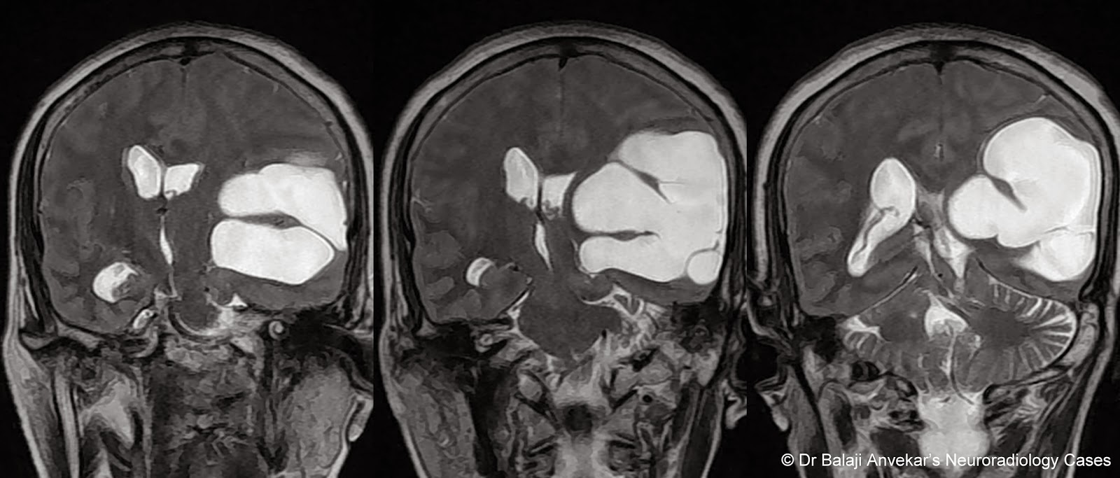 Dr Balaji Anvekar Frcr Left Parietal Cyst Mri