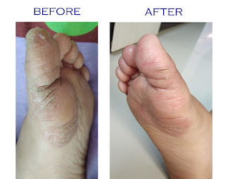 How to treat cracked or dry skin on toes due to dryness - My Review Hall