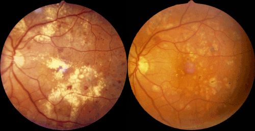 Medical Treatment Pictures-for Better Understanding: Retinal Laser ...