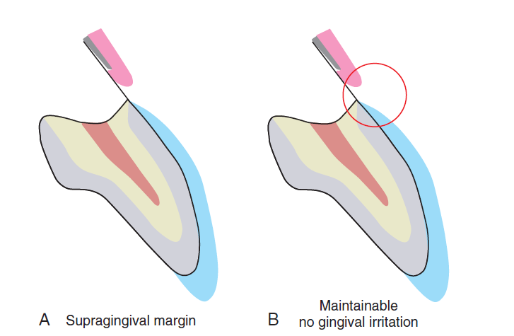 Clinical considerations in Veneers Preparations | Dental Esthetics