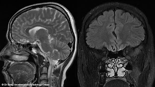 Dr Balaji Anvekar FRCR: Cysts in gyrus rectus of frontal lobe