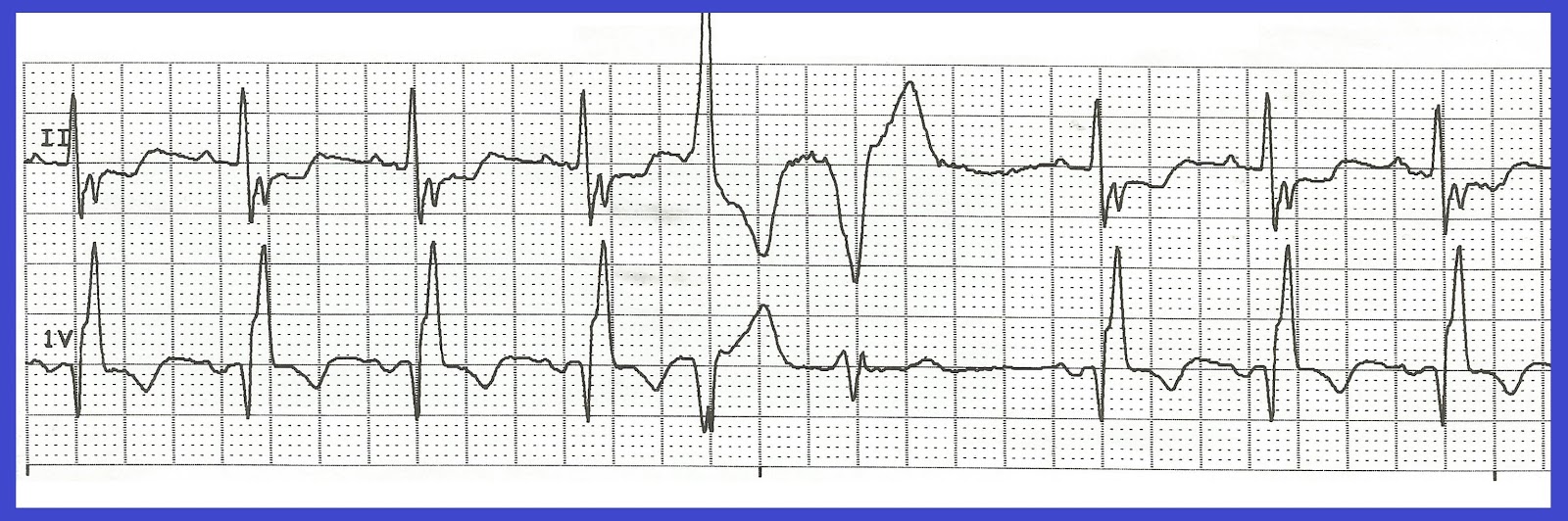 Practice EKG Rhythm Strips 195