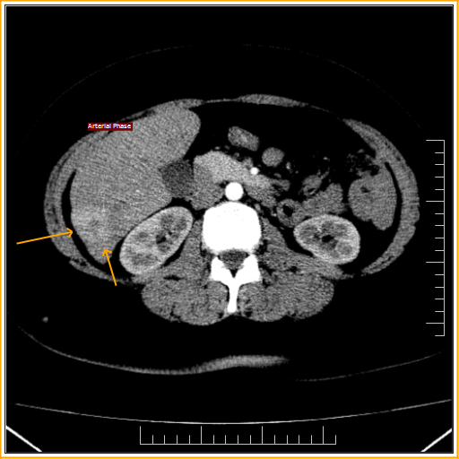 Focal Nodular Hyperplasia: CT - Sumer's Radiology Blog