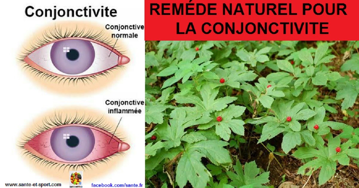 Conjonctivite : Soins naturels qui marchent ~ Sport et Santé