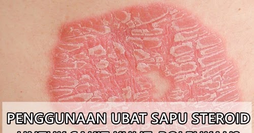 Penggunaan Ubat Sapu Steroid Untuk Penyakit Kulit, Bolehkah? - Aerill ...