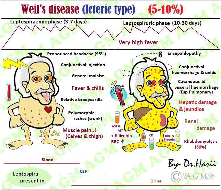 Weils Disease - Leptospirosis.