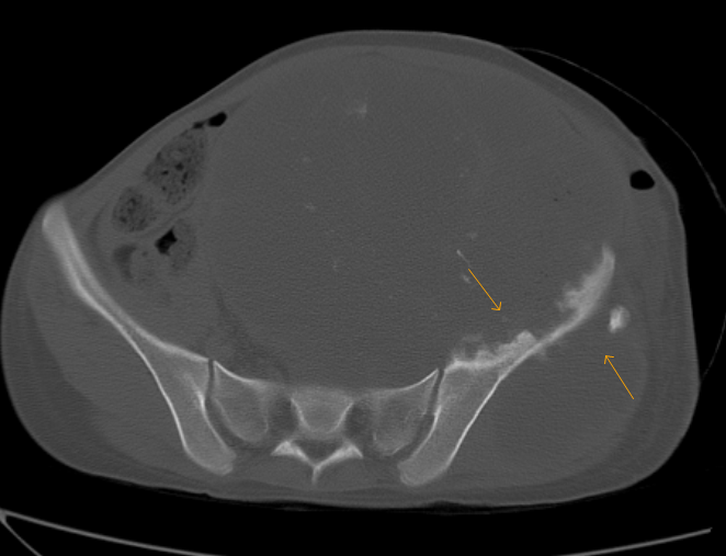Pelvic Osteosarcoma-CT - Sumer's Radiology Blog