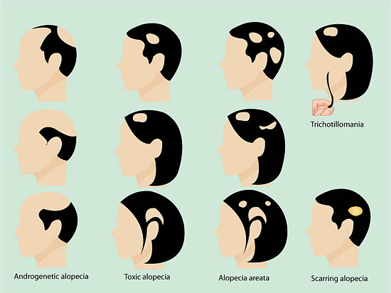 Hair growth tips and facts: Alopecia causes Treatment and Prevention Hair growth tips and facts: Alopecia causes Treatment and Prevention