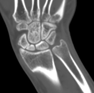 Joint Preservation and Replacement : SNAC wrist Stage 3(Vender)