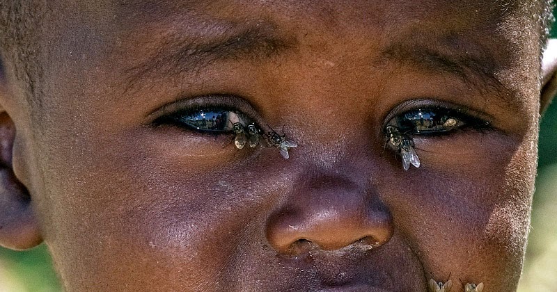 Enfermedades infecciosas: Oncocercosis