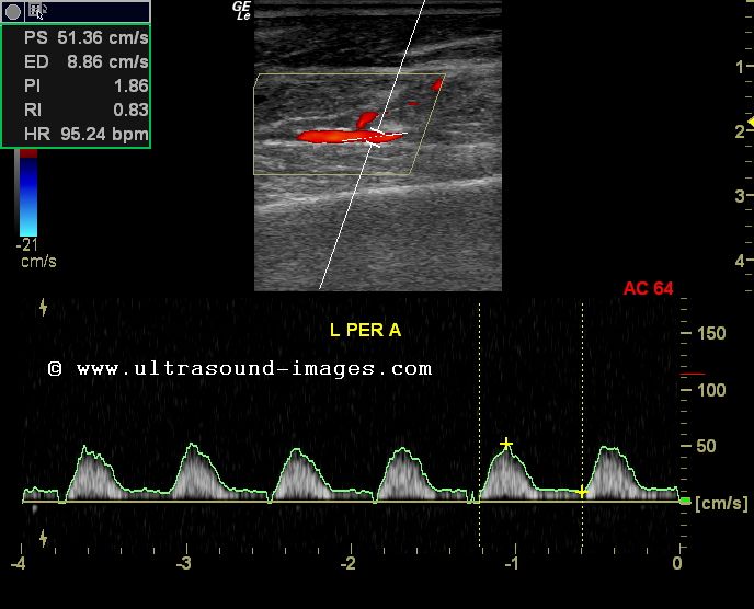 cochinblogs: Doppler study-Severe stenosis of the lower limb arteries