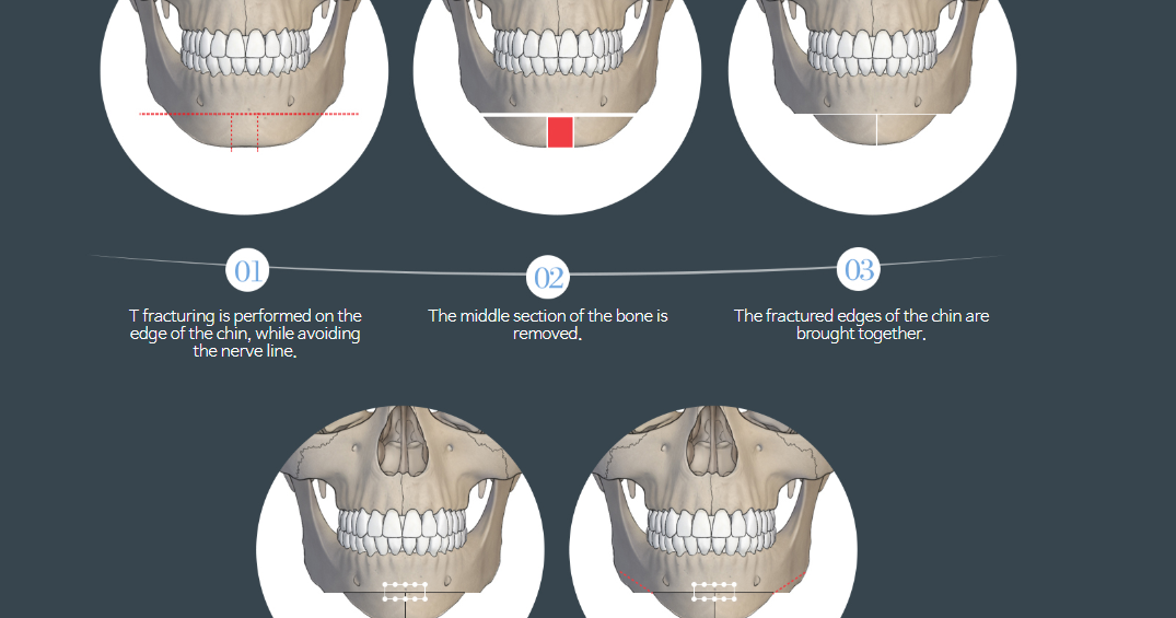 What is mini V-line Surgery?