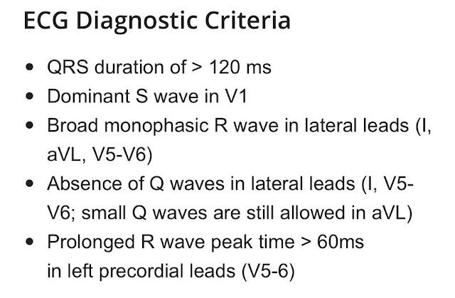 LBBB (IN ECG) CRITERIA
