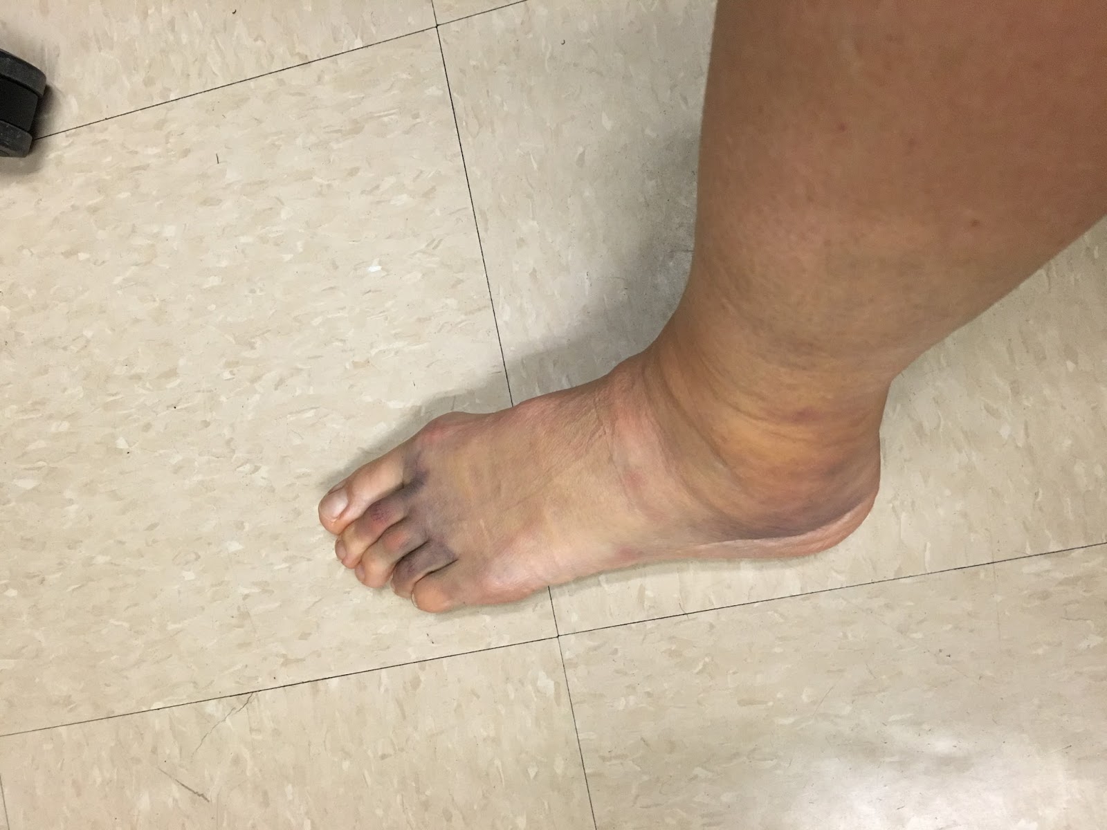 The Life and Times of Jordan!: More Ugly Foot Pictures