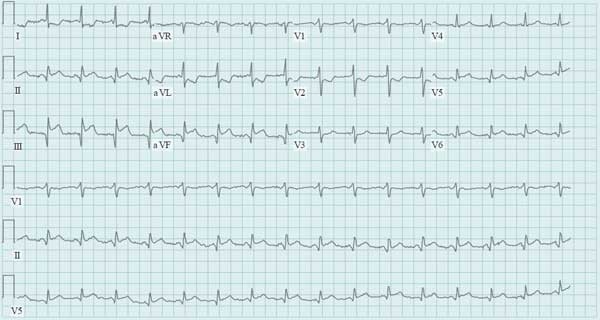 Acute Right Ventricular Failure Complicating Myocardial Infarction Case ...