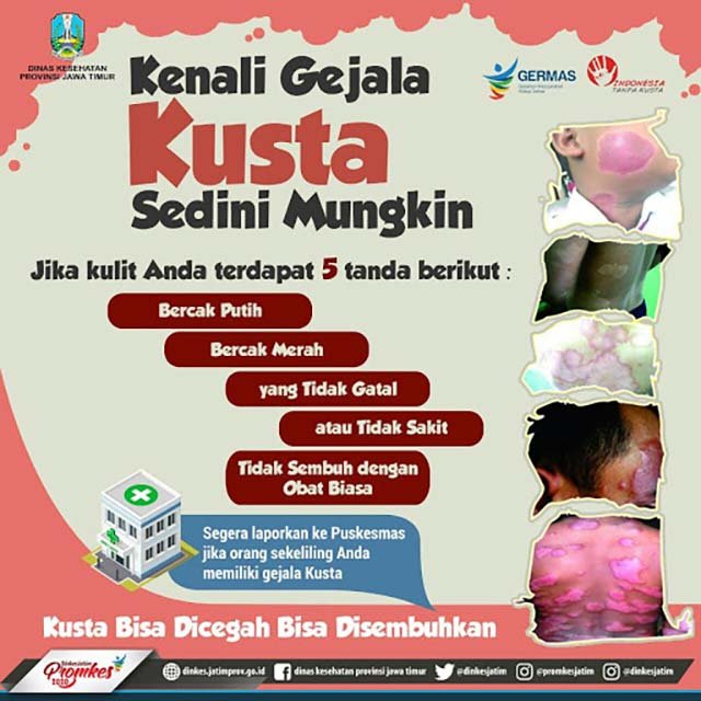 Disabilitas Kusta, Cara Mengatasinya dan Cara Mendukung Penyandang Kusta