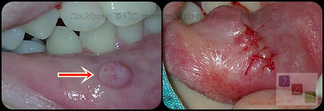 Irritation Fibroma of The Lower Lip