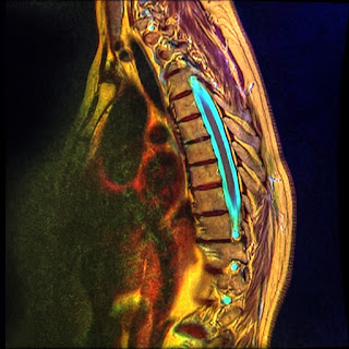 Nevit's blog: Dorsal Spine Color MRI