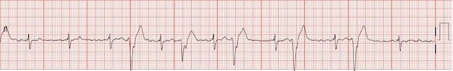 EKG Rhythm Strip Quiz 22
