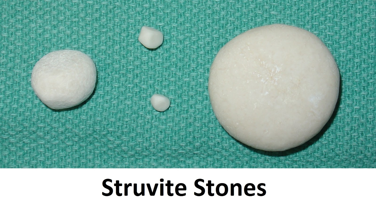 Kidney Stone: Symptoms, Causes, Treatment, and its homeopathic ...