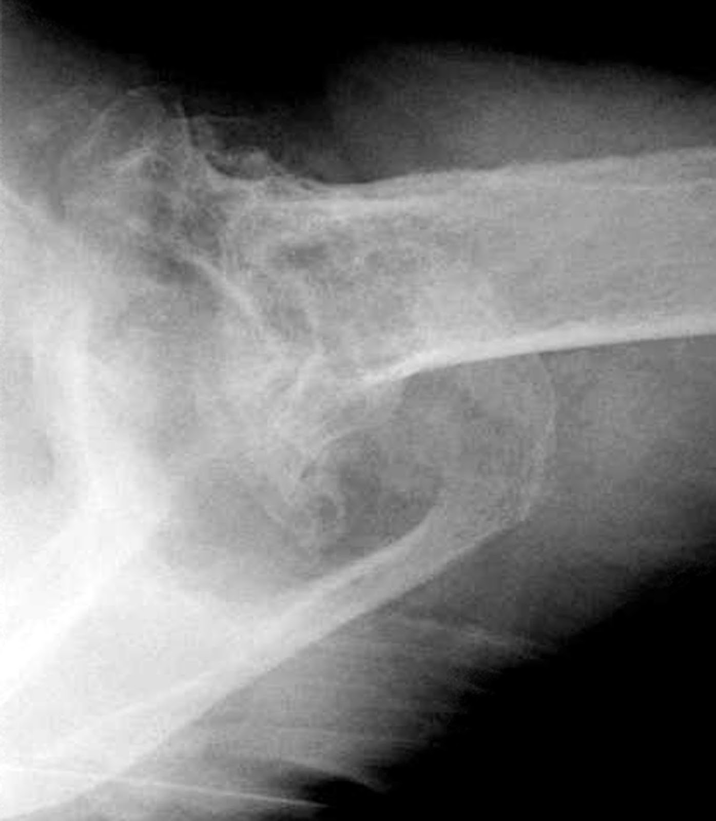 UW Shoulder and Elbow Academy: Shoulder joint replacement - many ...