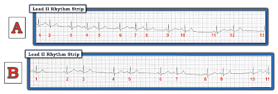 ECG Interpretation: ECG Blog #174 (AV block – PACs – group beating)
