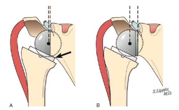 UW Shoulder and Elbow Academy: Reverse total shoulder - scapular ...