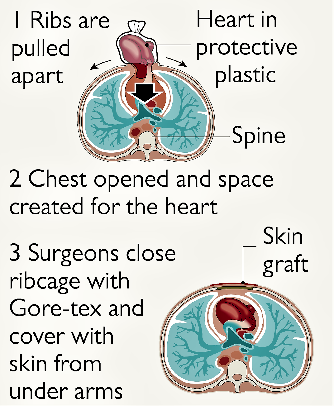 3rd Global Heart Congress Ectopia Cordis A Rare Heart Disease