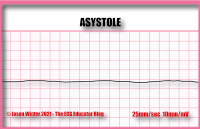 ECG Educator Blog : 11/14/16