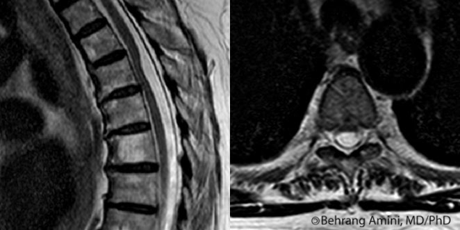 Roentgen Ray Reader: Spinal Epidural Fluid Collection