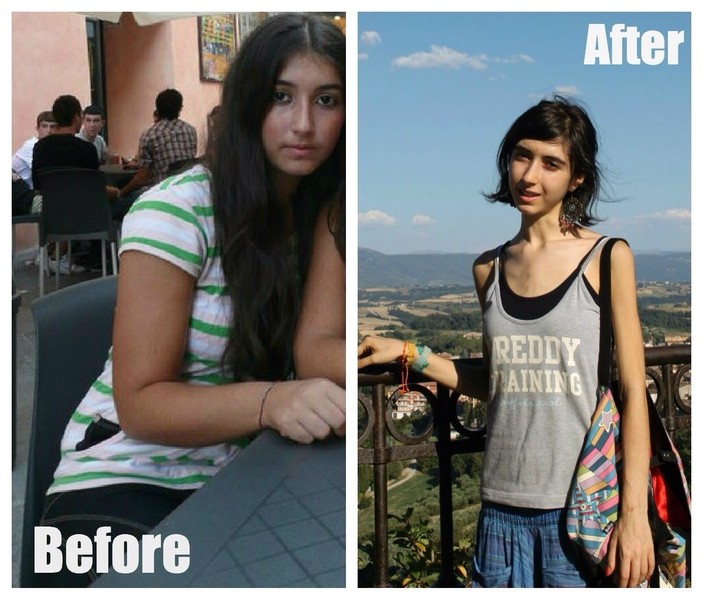 Extreme Thinspo | Real Girls: Thinspo: Before and After