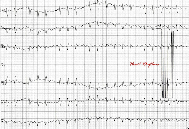 Atrial Flutter Life In The Fast Lane Ecg Library