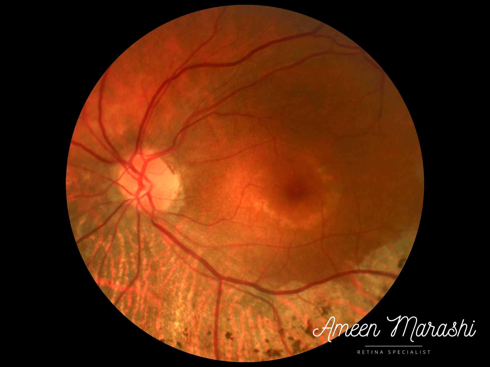 Sectoral retinitis pigmentosa