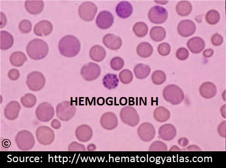 Lab Atlas: Hemoglobin H