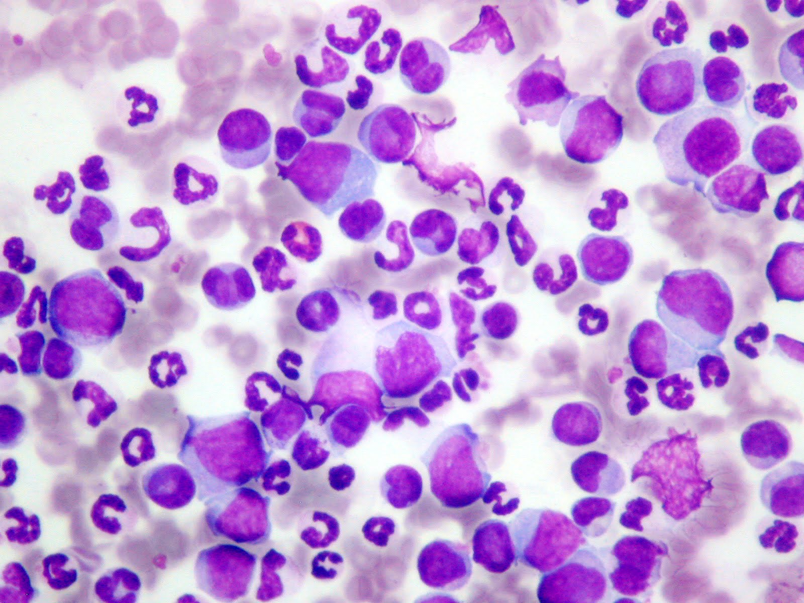 Fichero de Hematología: Anormalidades leucocitarias