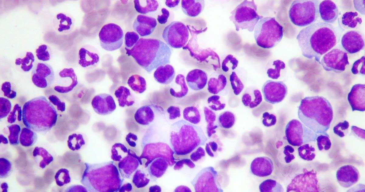 Fichero de Hematología: Anormalidades leucocitarias
