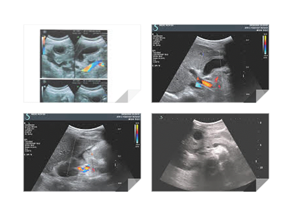 VIETNAMESE MEDIC ULTRASOUND: CASE 363: MURPHY'S SIGN POSITIVE, Dr PHAN ...