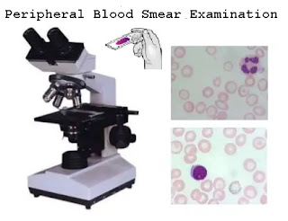 Examination of the Peripheral Blood smear