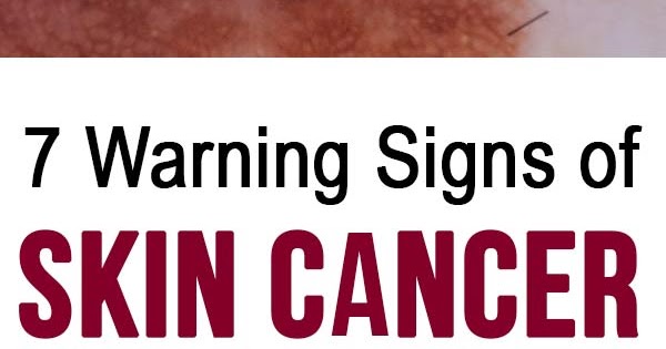 7 SKIN CANCER WARNING SIGNS YOU SHOULD NEVER IGNORE - medicine health life