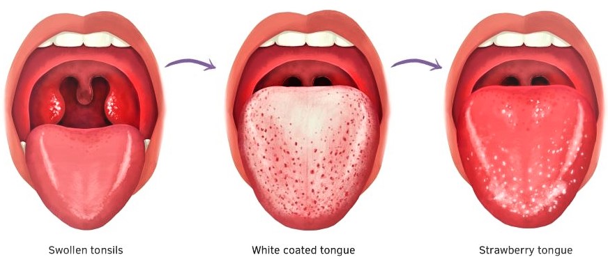 Zippo Idee: LO QUE DEBES SABER DE - Escarlatina