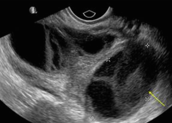 Pelvic Inflammatory Disease and Tubo-Ovarian Abscess
