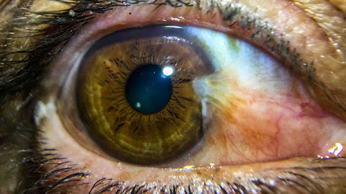 Pterygium, Cause, Symptoms and Treatment - Eye Health Nepal