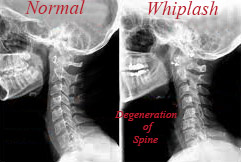 If you were recently in a car accident: Whiplash Treatment Guidelines