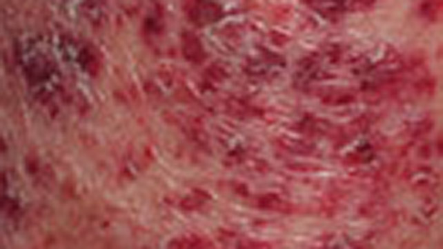 Recognize and Treat an Anemia Rash[हिन्दी]