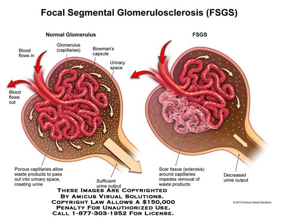 Renal-disease: What do you know about Focal Segmental ...