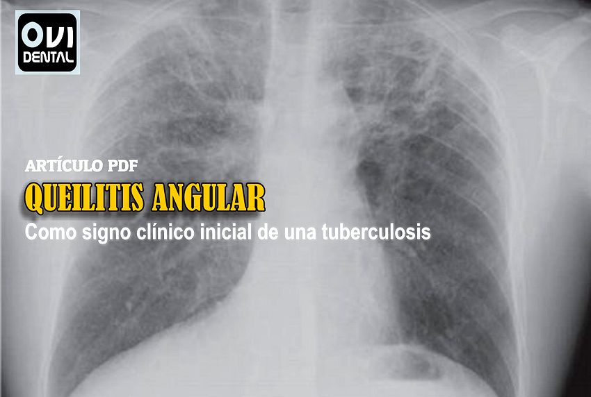 PDF: Queilitis Angular como signo clínico inicial de una tuberculosis