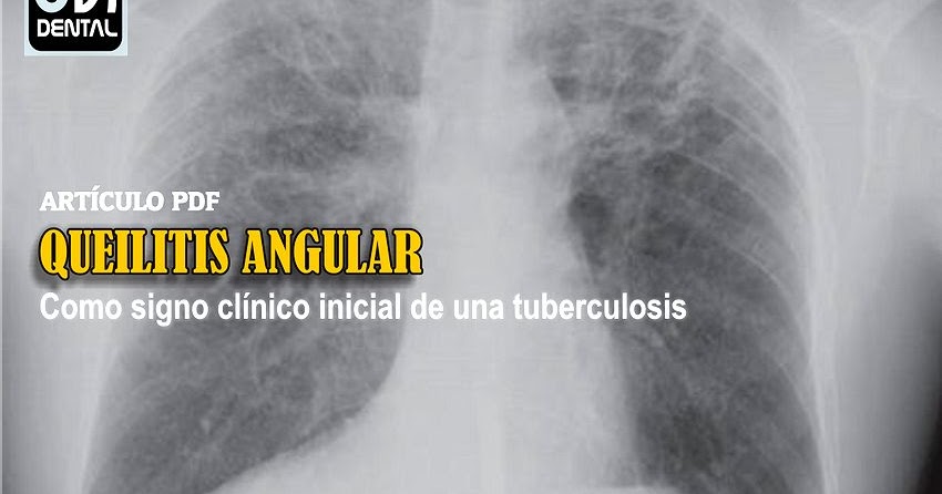 PDF: Queilitis Angular como signo clínico inicial de una tuberculosis ...