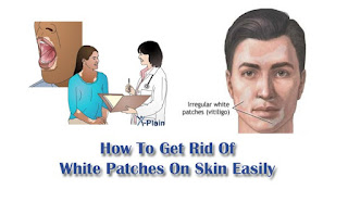 How To Get Rid Of White Patches On Skin Easily - MyHealth.com