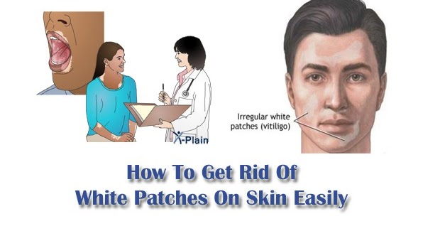 How To Get Rid Of White Patches On Skin Easily - MyHealth.com